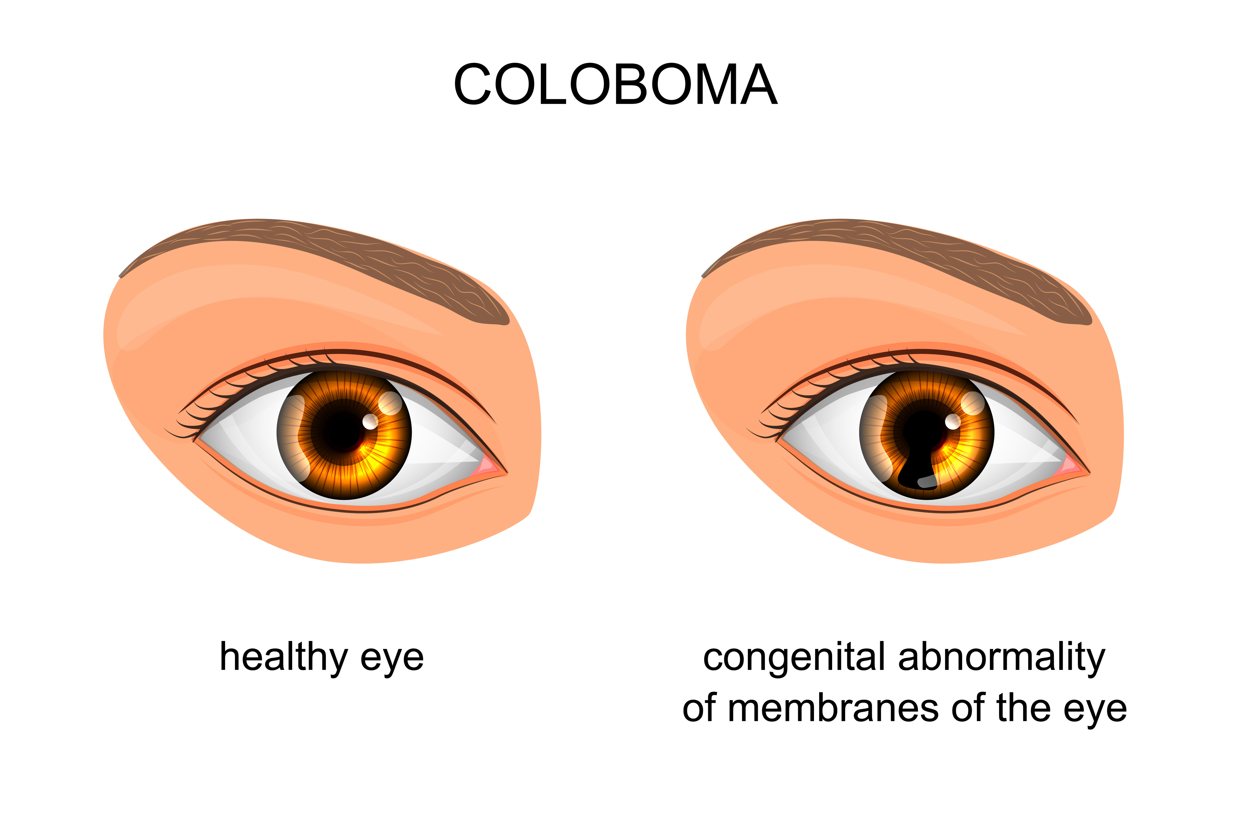 Coloboma: Types, Symptoms, and Associated Conditions