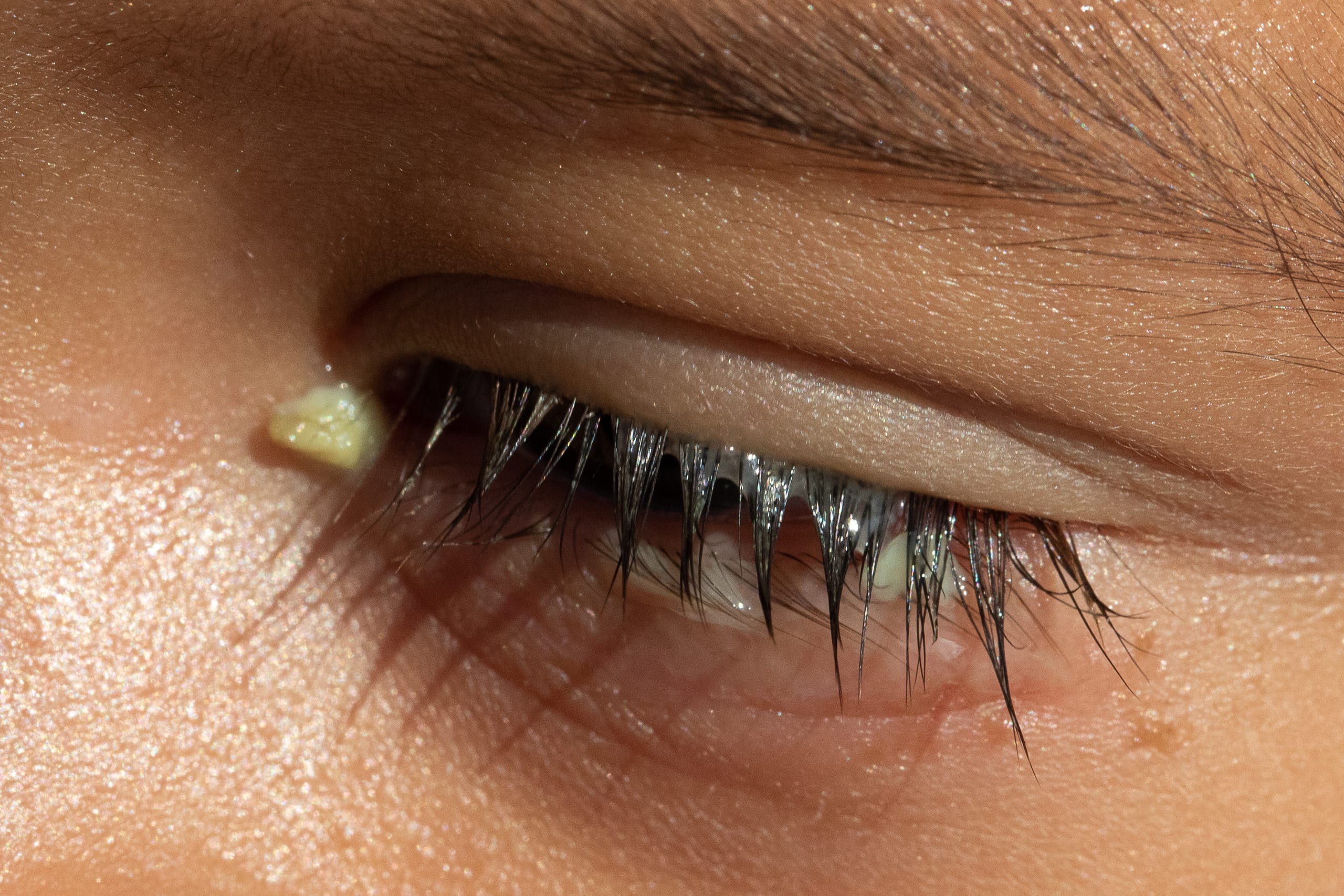 Crusty Eyes in the Morning: Causes & Treatment