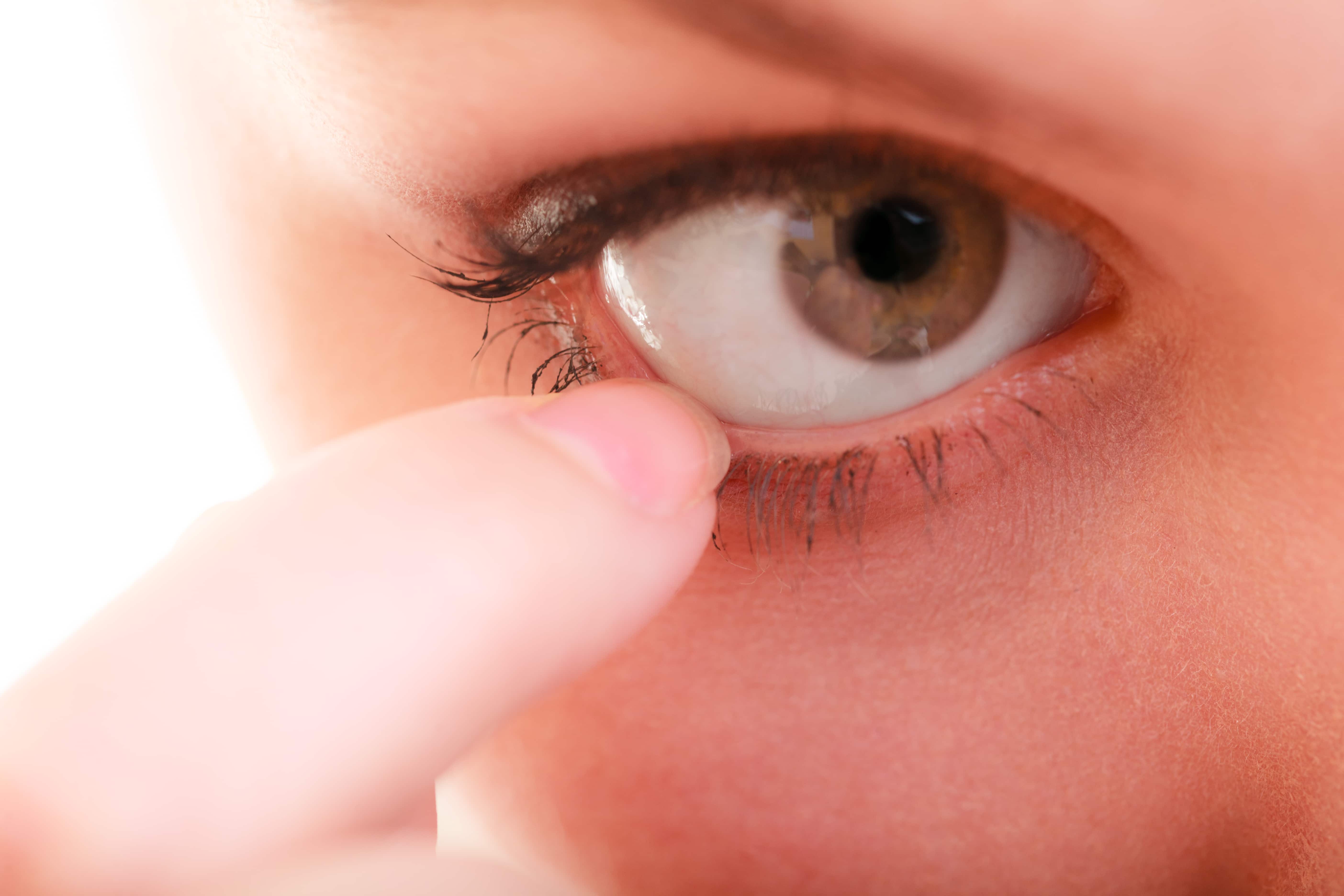 Ingrown Eyelash - Causes, Symptoms & Treatment
