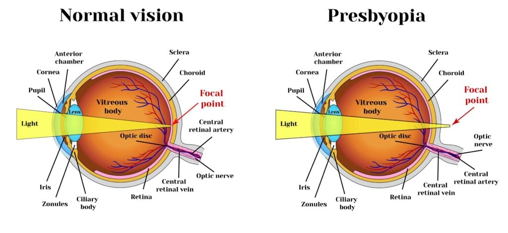 Can Eyesight Improve With Age 2023 