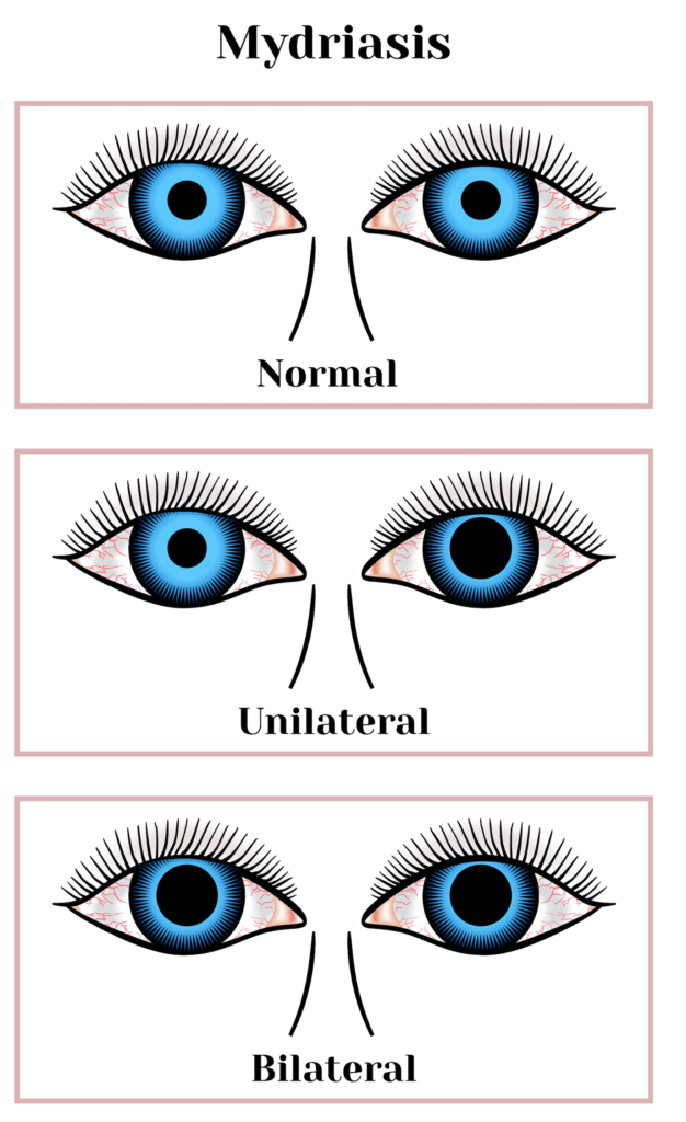 How To Cure Dilated Pupils Theatrecouple12