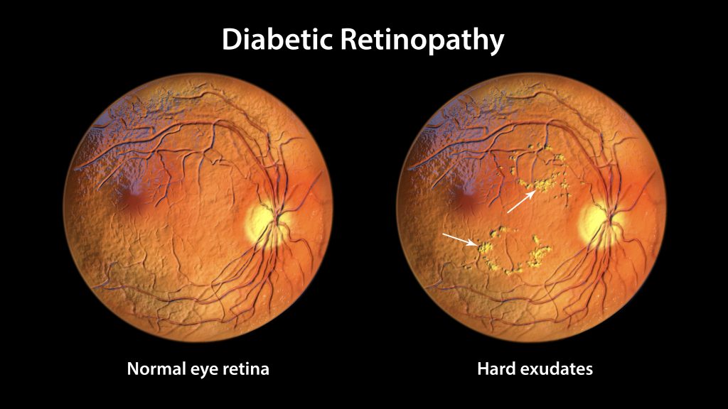 Diabetic Eye Exam What To Expect Costs And How Often