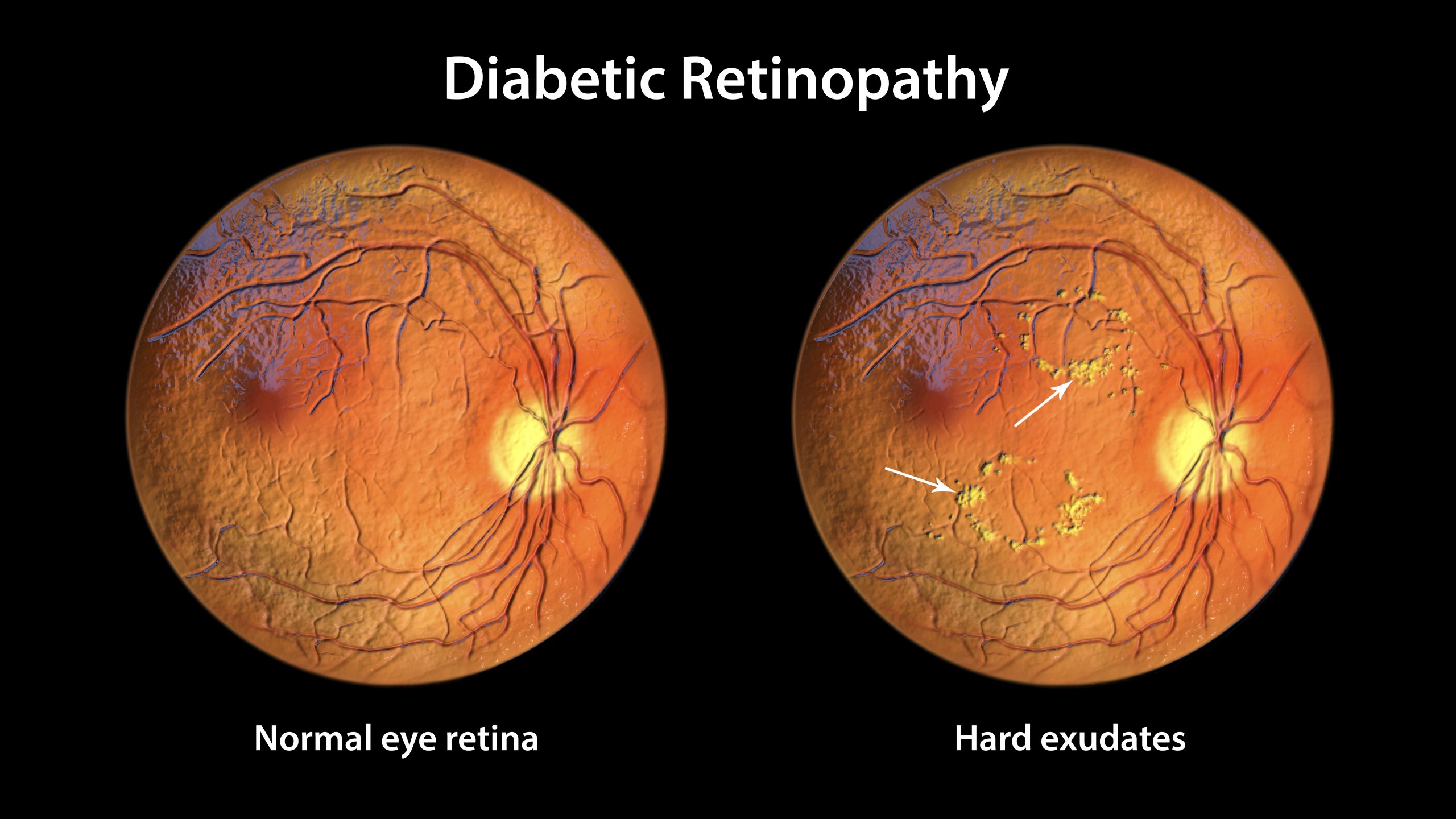 Diabetic Retinopathy Symptoms Causes Treatment 